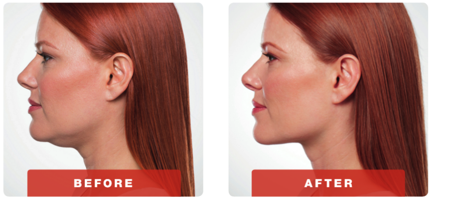 Kybella Bluffton | Double Chin Reduction Hilton Head